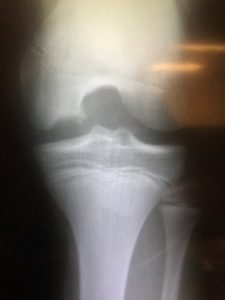 Osteochondritis Dissecans (OCD) – Ortho Rhode Island
