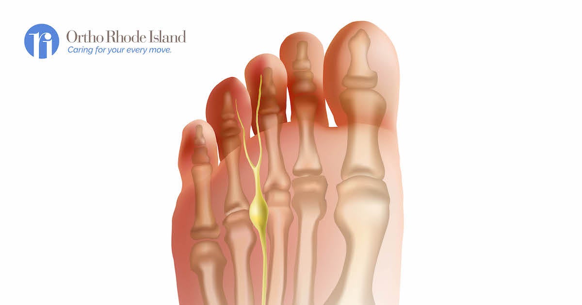 Alcohol Sclerosing Injections as an Alternative to Surgery in the ...